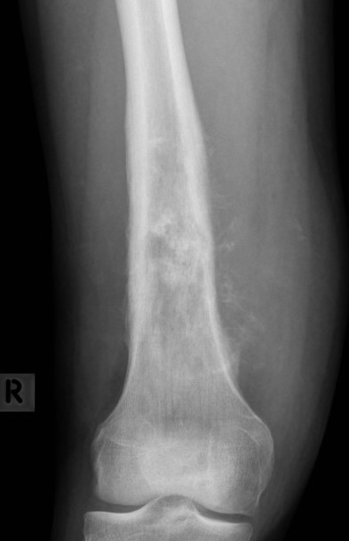 Conventional Osteosarcoma | The Bone School